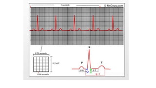 ECG-REVISION final yr physiotherapy .pptx