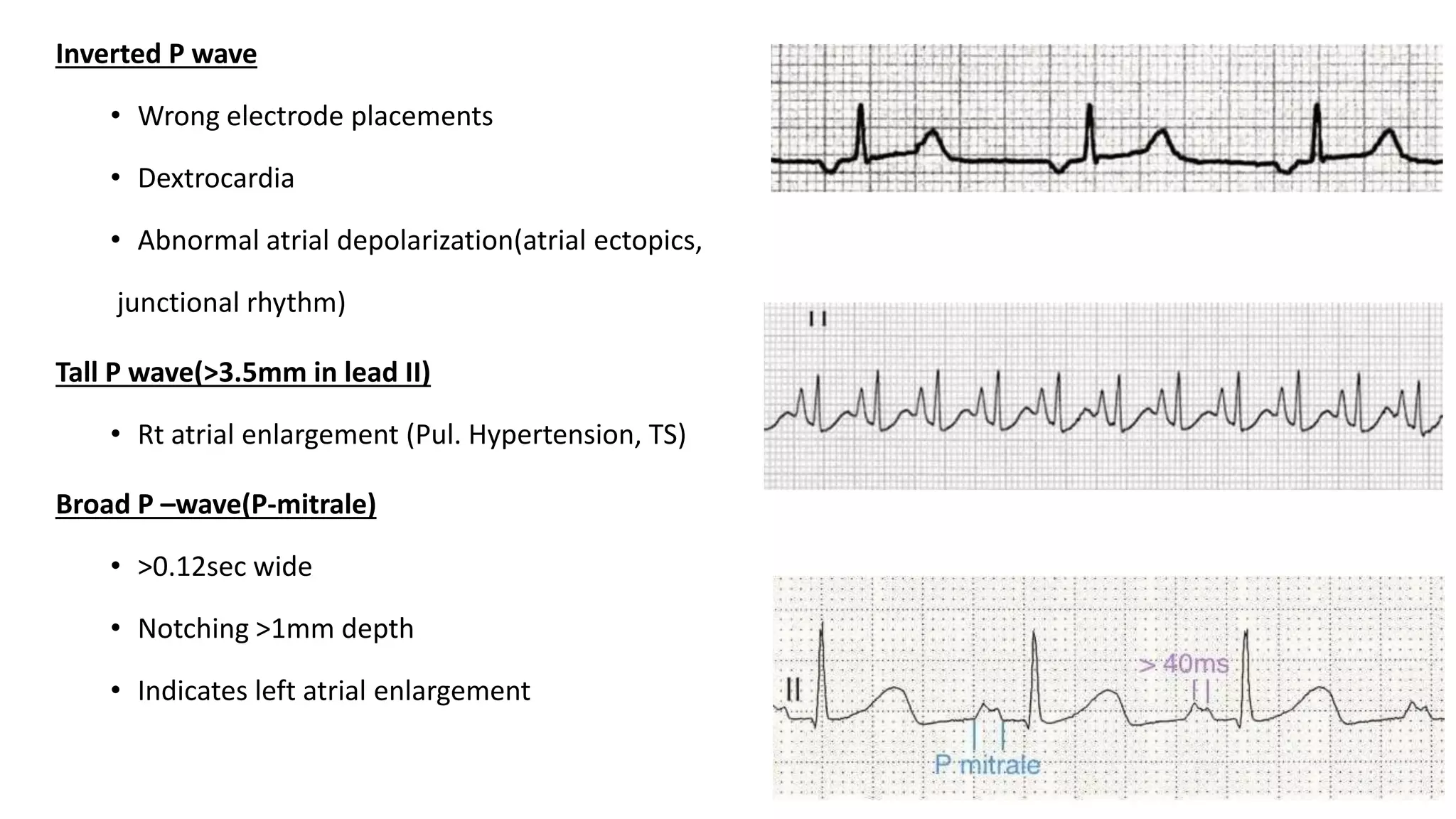 Ecg made easy | PPTX
