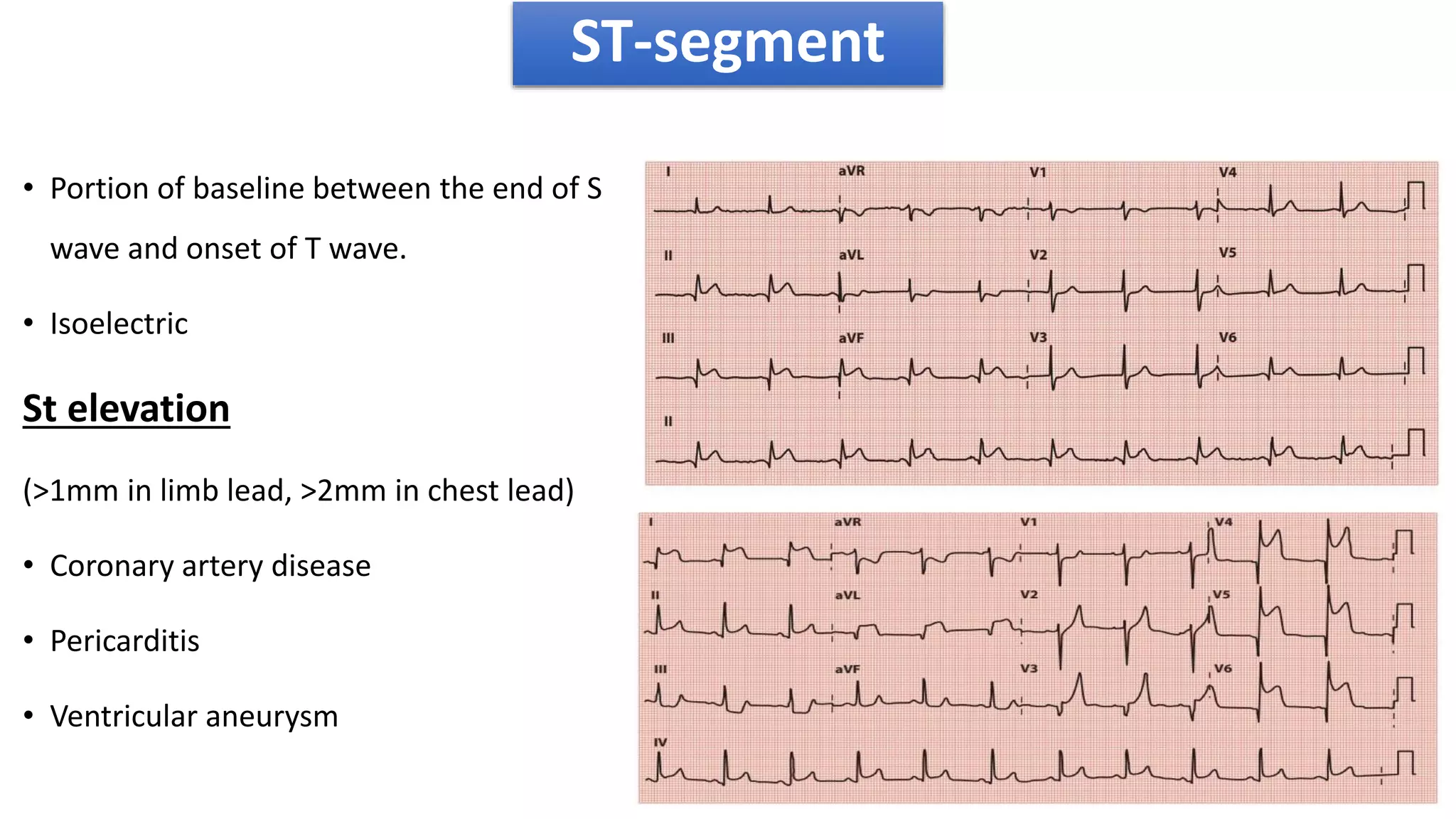 Ecg made easy | PPTX