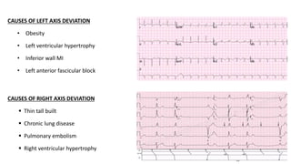 Ecg made easy | PPTX