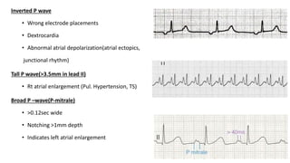 Ecg made easy | PPTX