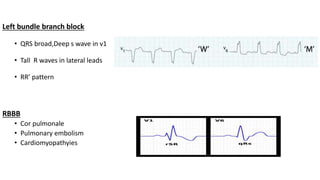 Ecg made easy | PPTX