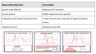 Ecg made easy | PPTX