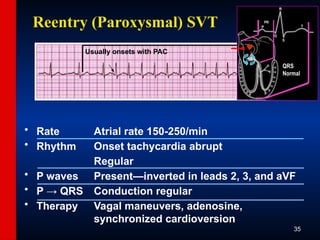 ECG-Slide-Set.pptx the basics of ECG reading | PPTX