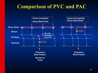 ECG-Slide-Set.pptx the basics of ECG reading | PPTX