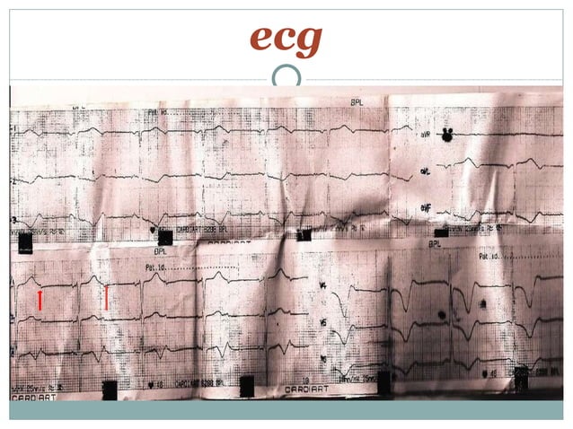 ECG - AV Block | PPT
