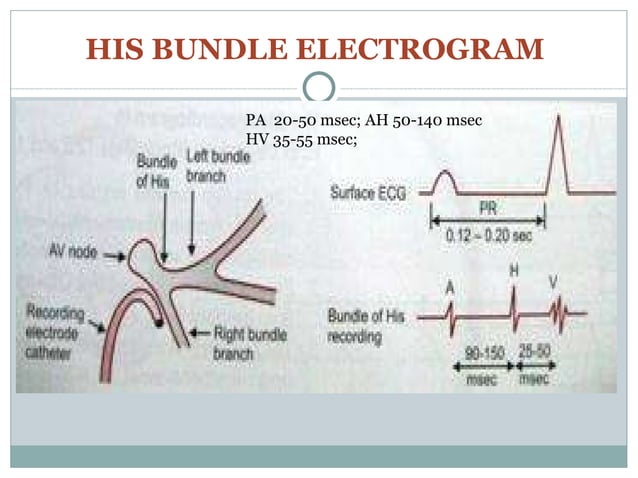 ECG - AV Block | PPT