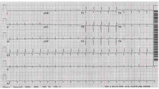 ecg-stumper-case-for-mecg-or-other-case-conferences | PPTX