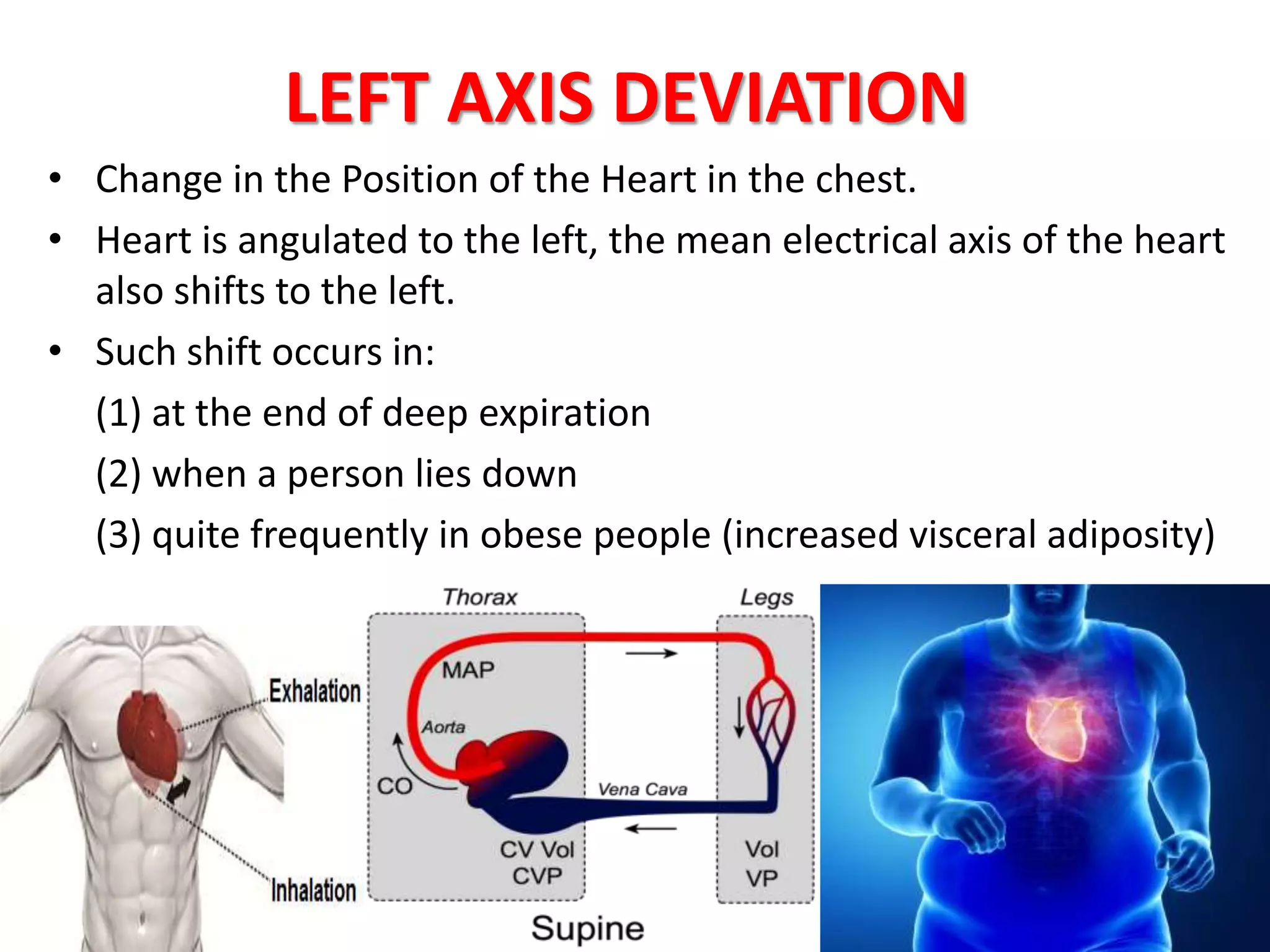 Ecg- Vector Analysis | PPTX
