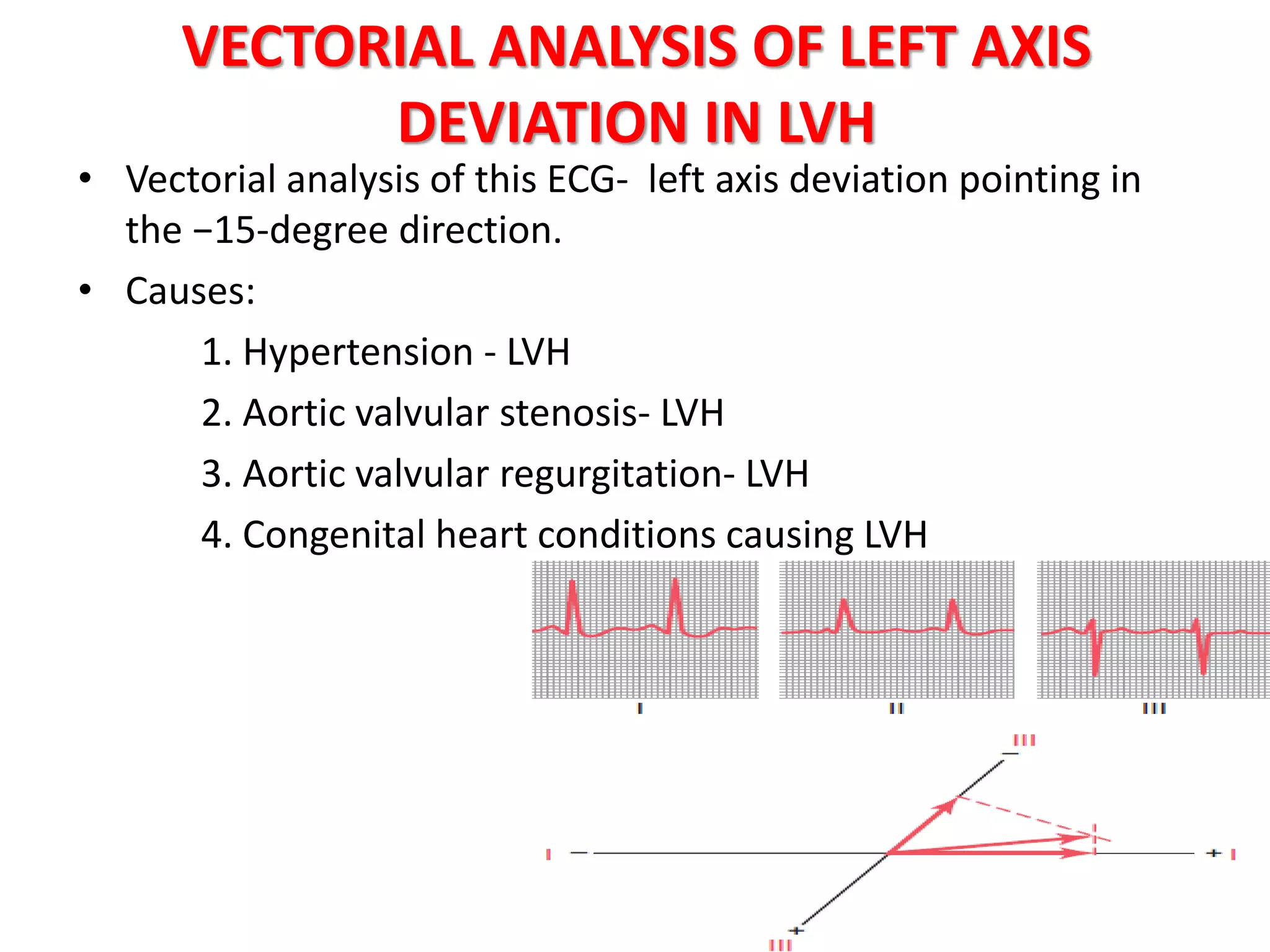 Ecg- Vector Analysis | PPTX