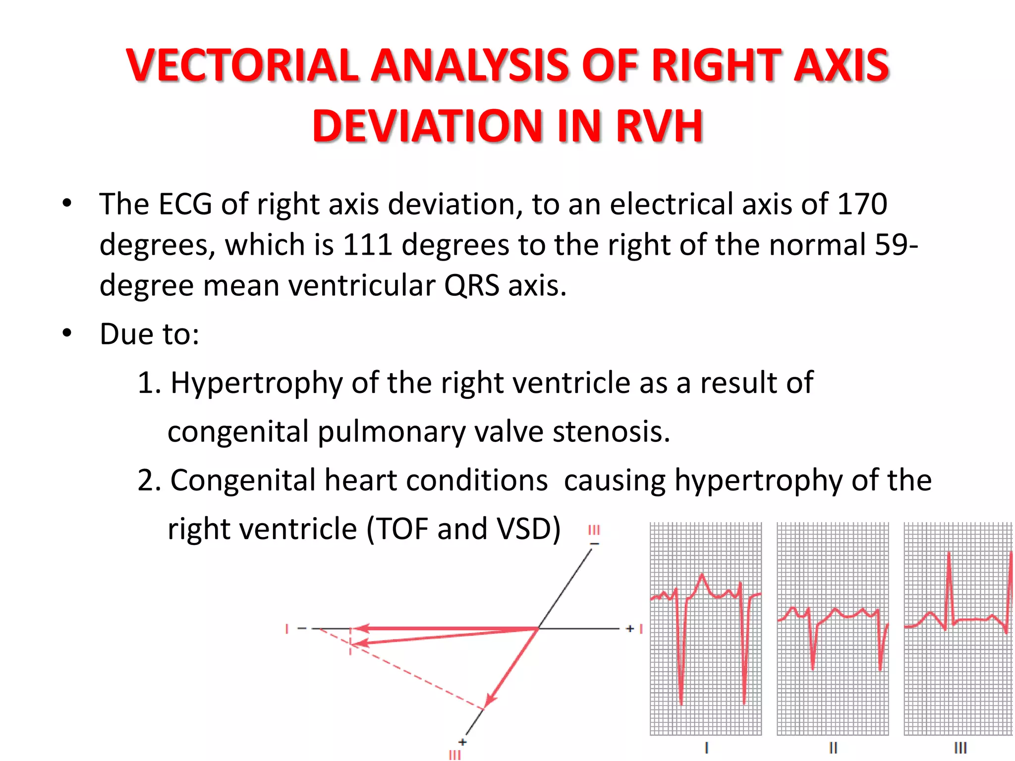 Ecg- Vector Analysis | PPTX