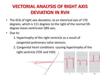Ecg- Vector Analysis | PPTX