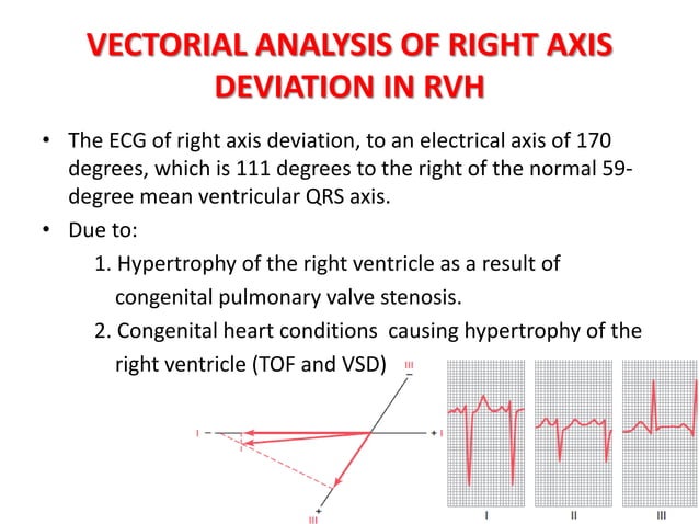 Ecg- Vector Analysis | PPTX