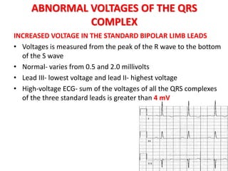 Ecg- Vector Analysis | PPTX