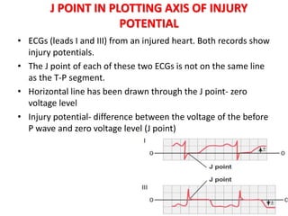 Ecg- Vector Analysis | PPTX