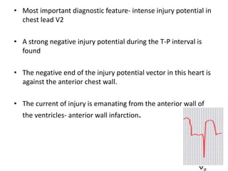 Ecg- Vector Analysis | PPTX