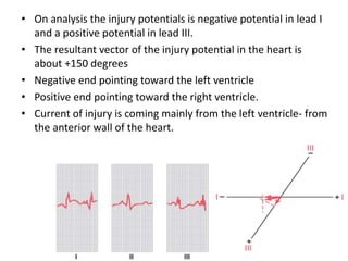 Ecg- Vector Analysis | PPTX