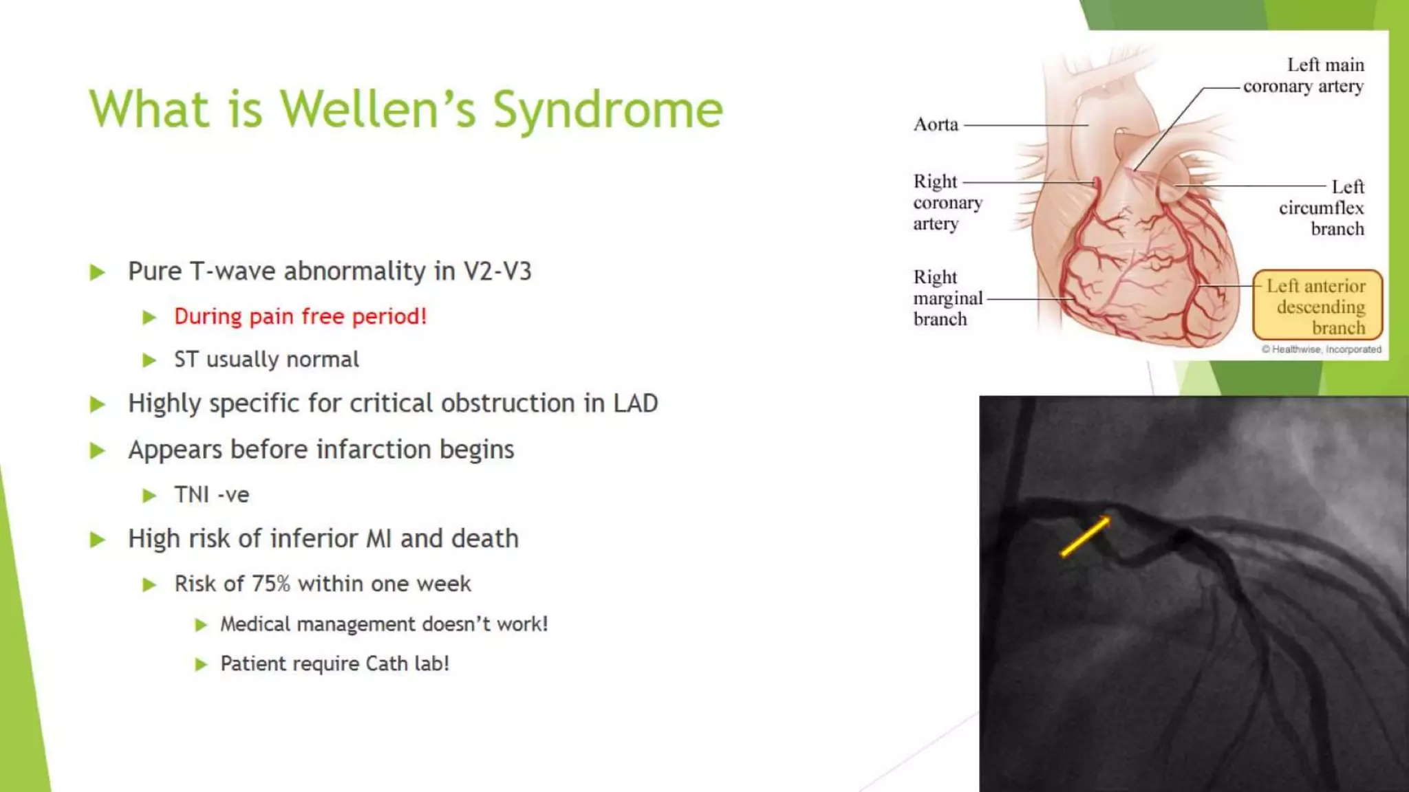 ECG Wellen's sign and Widow maker sign presentation | PPTX