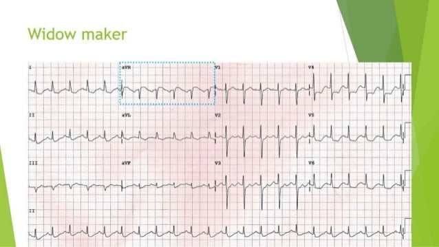 ECG Wellen's sign and Widow maker sign presentation