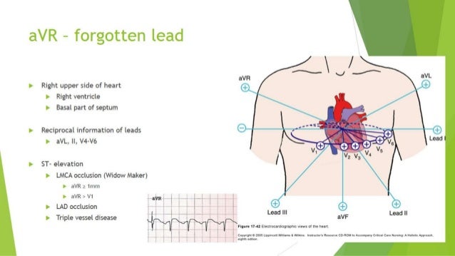 ECG Wellen's sign and Widow maker sign presentation