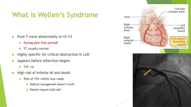ECG Wellen's sign and Widow maker sign presentation