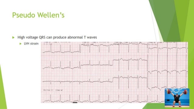 ECG Wellen's sign and Widow maker sign presentation