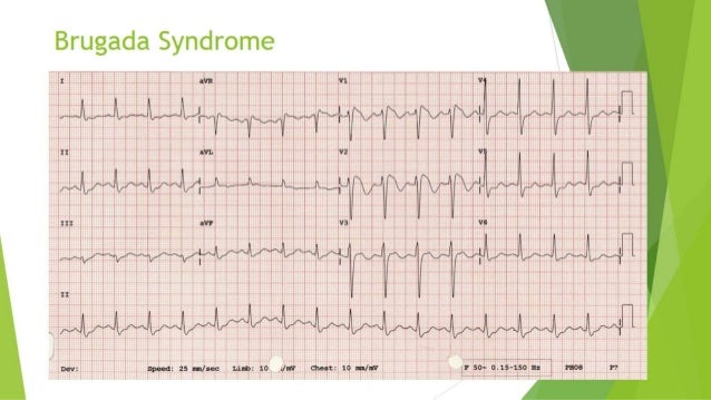 ECG Wellen's sign and Widow maker sign presentation