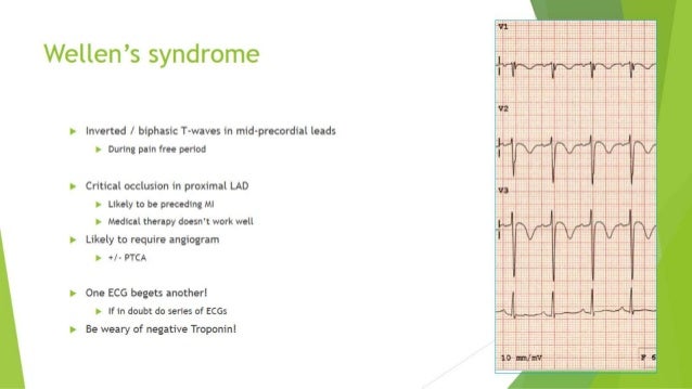 ECG Wellen's sign and Widow maker sign presentation
