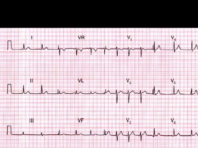 Electrocardiography | PPTX | Heart and Cardiovascular Diseases ...