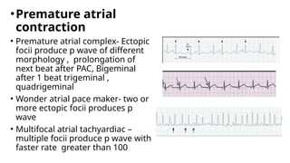 ECG[1]bjkjgfjkkjhfffffgjhgfujuhghjjg.pptx