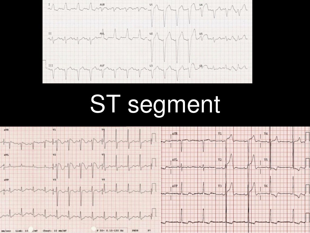 ECG 101