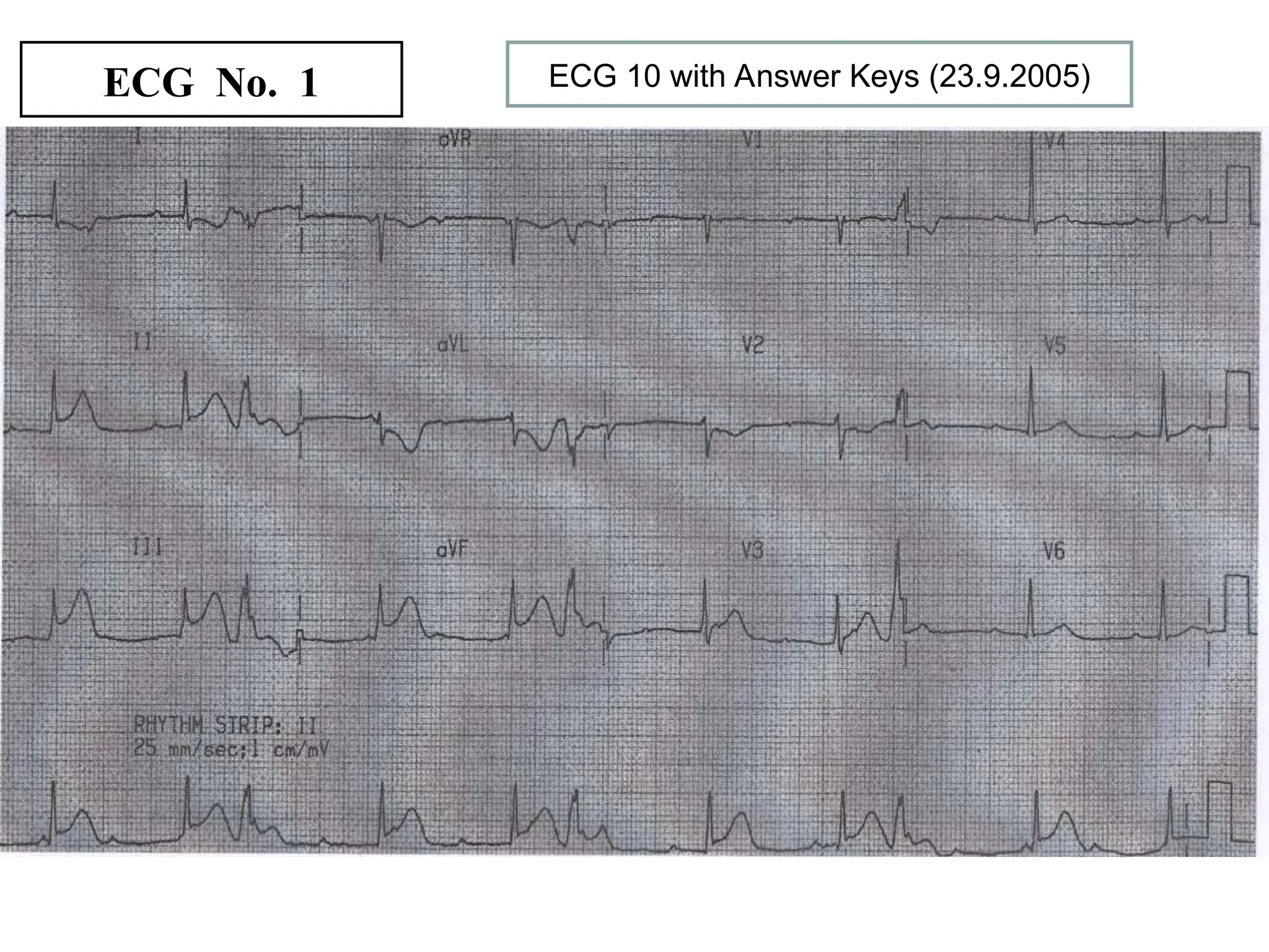 ECG 10 with Answer Keys (23.9.2005).ppt