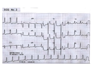 ECG 10 with Answer Keys (23.9.2005).ppt