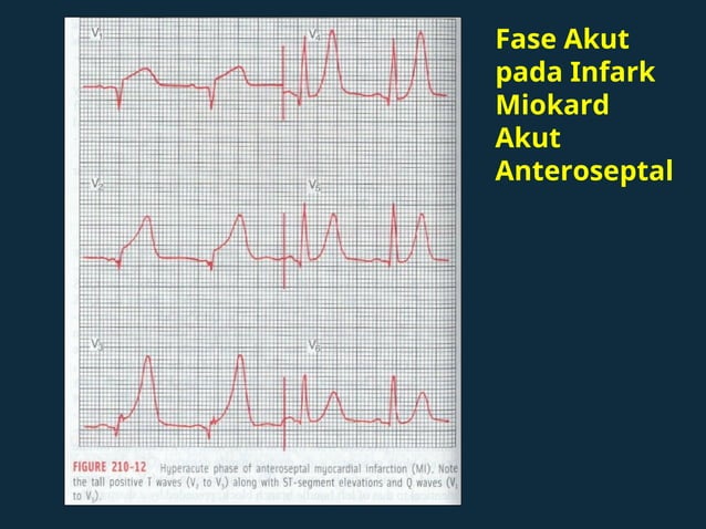 Cara membaca ecg dan interpretasi elektocardiogram | PPT