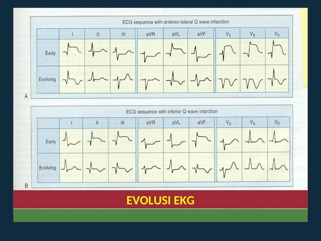 Cara membaca ecg dan interpretasi elektocardiogram | PPT