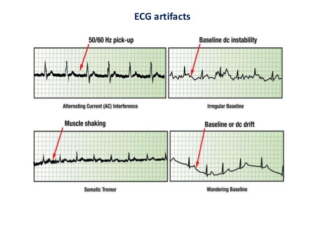 Ecg123