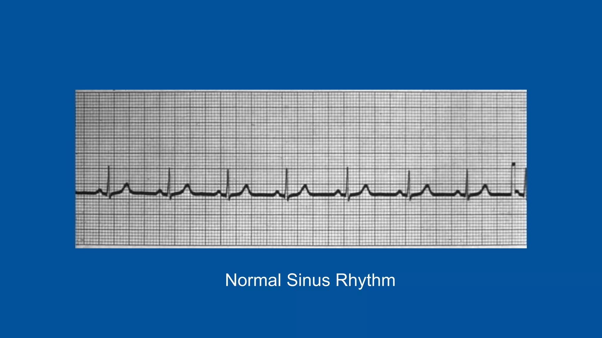 Ecg & 12 lead ecg | PPTX