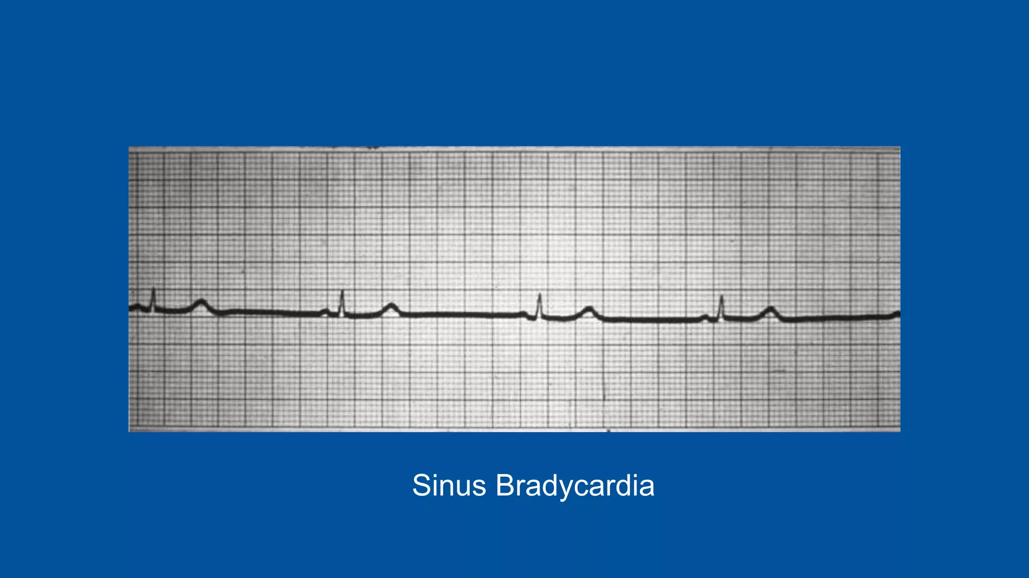 Ecg & 12 lead ecg | PPTX