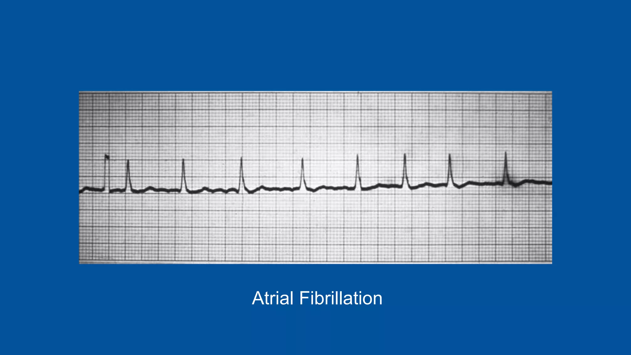 Ecg & 12 lead ecg | PPTX