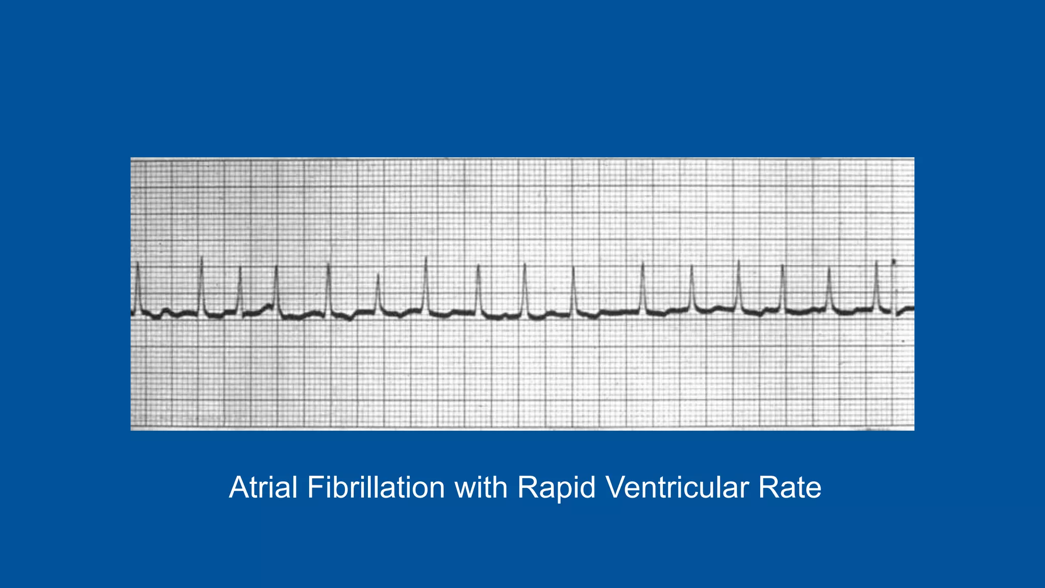 Ecg & 12 lead ecg | PPTX