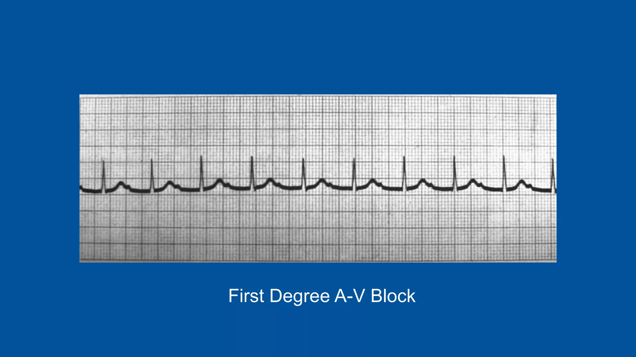Ecg & 12 lead ecg | PPTX