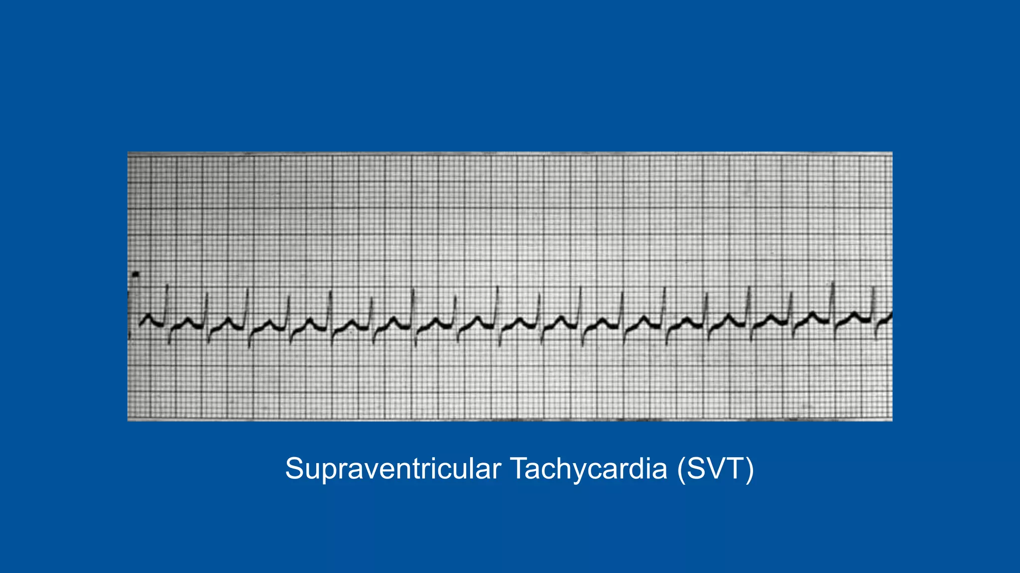 Ecg & 12 lead ecg | PPTX