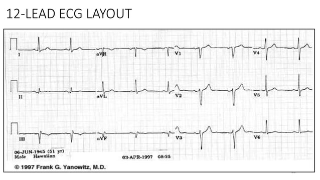 Ecg & 12 lead ecg | PPT