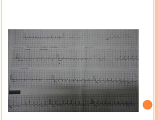 ECG: Reciprocating tachycardia | PPTX