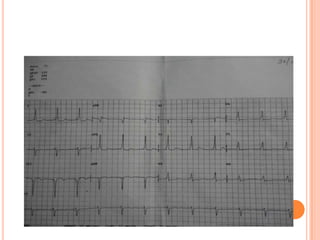 ECG: Reciprocating tachycardia | PPTX