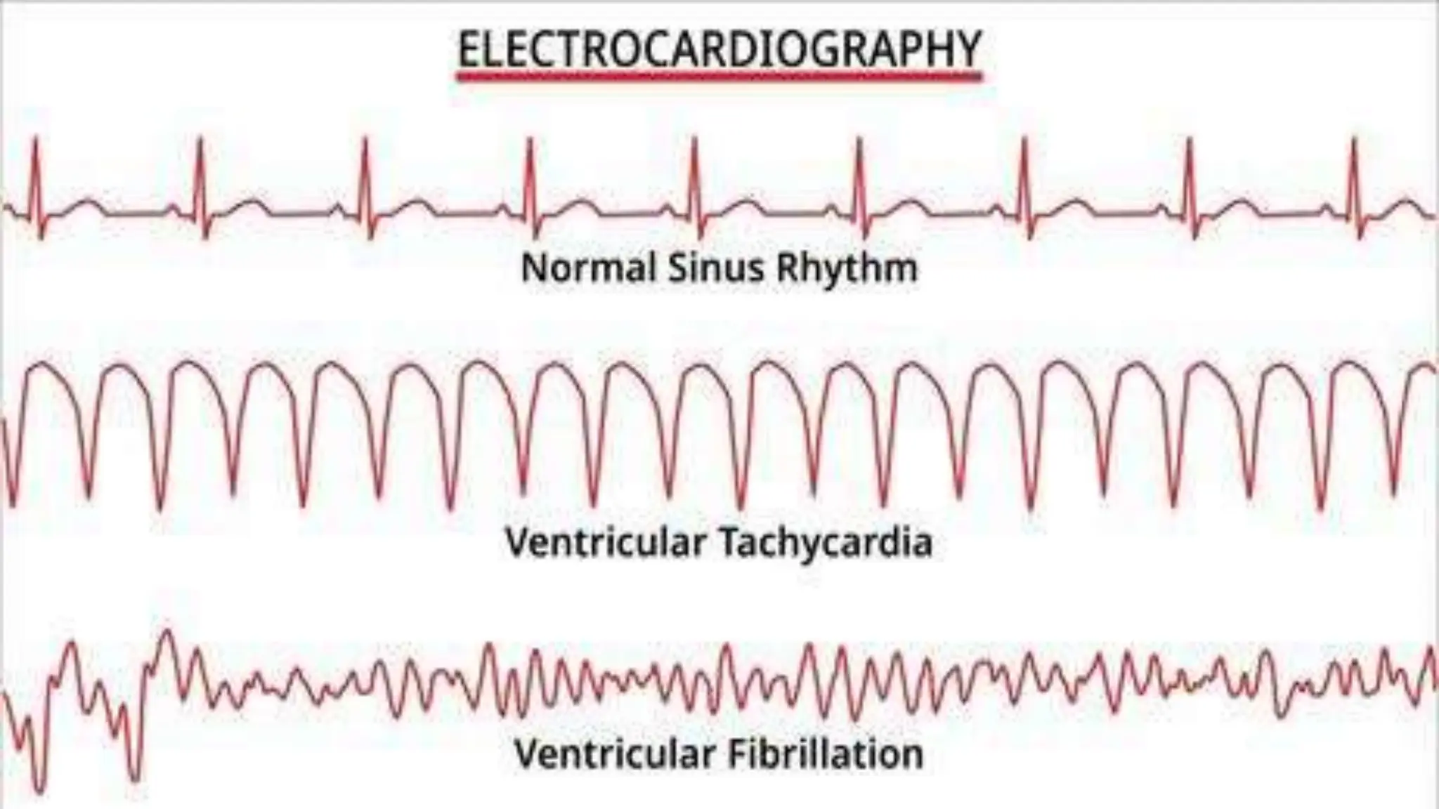 ECG basics simplified for students .pptx