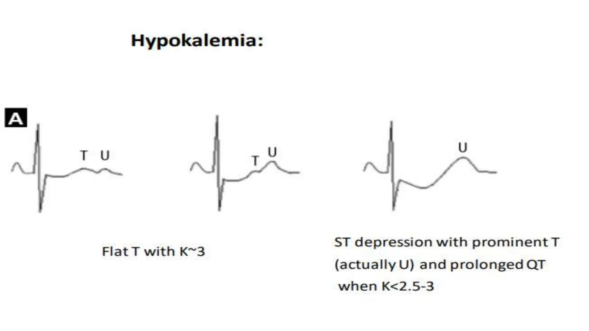 ECG basics simplified for students .pptx
