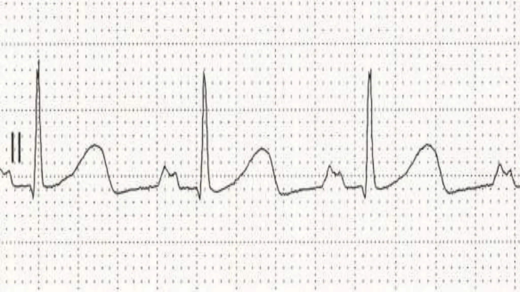 ECG basics simplified for students .pptx