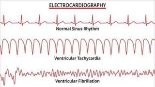 ECG basics simplified for students .pptx