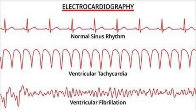 ECG basics simplified for students .pptx